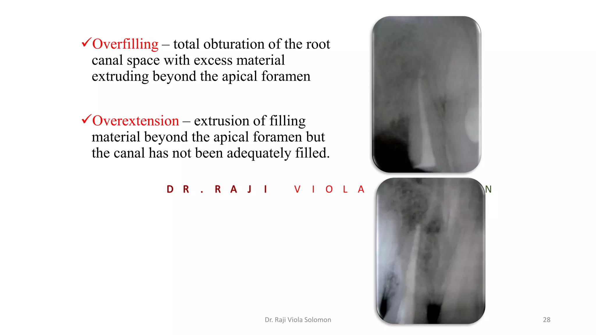 Obturation.of.the.Root.Canal.Space.Part1 | PDF