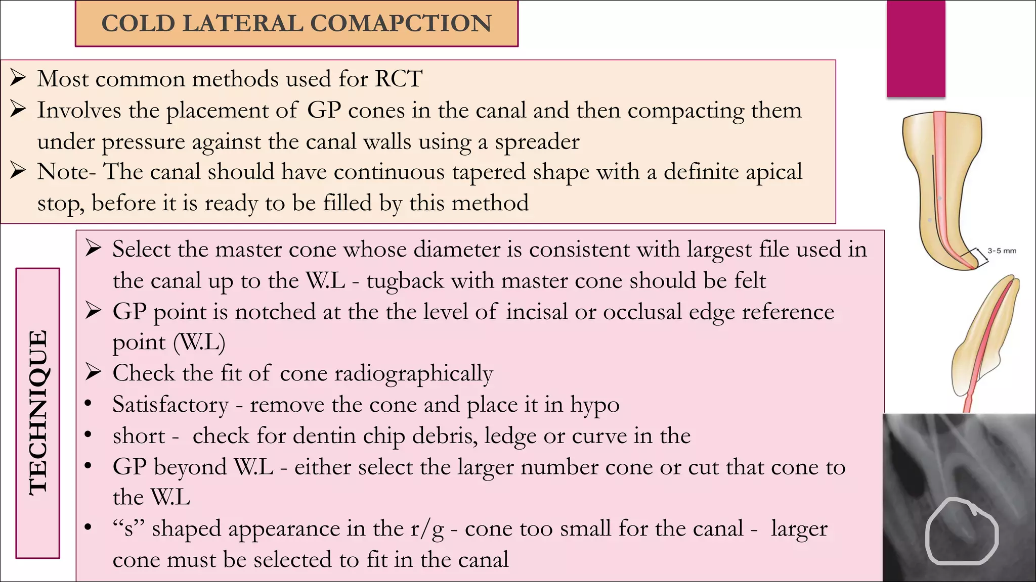 Obturation of Root canal systems or Root canal obturation | PDF