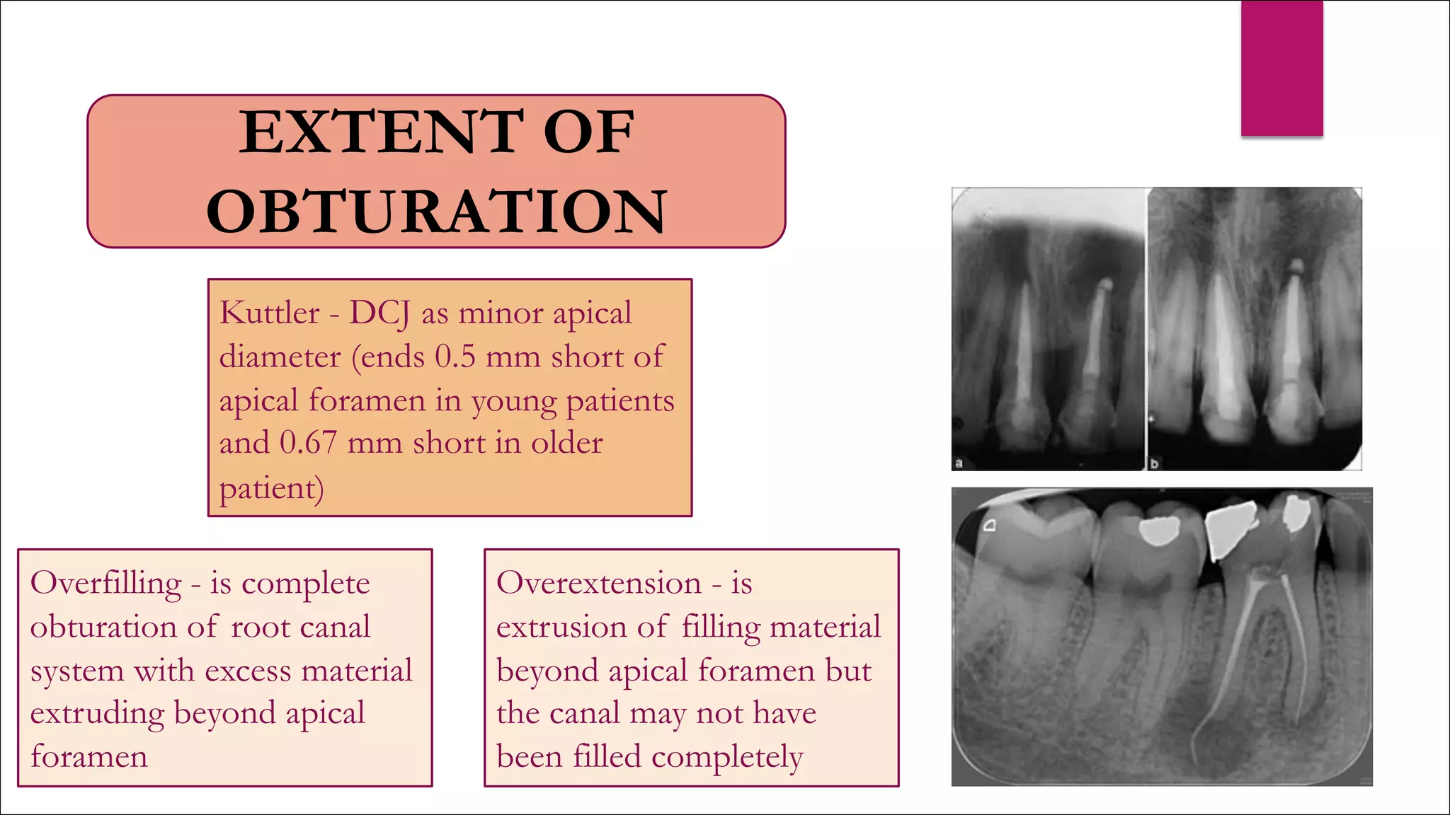 Obturation of Root canal systems or Root canal obturation | PDF