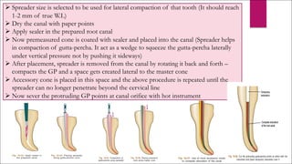 Obturation of Root canal systems or Root canal obturation | PDF
