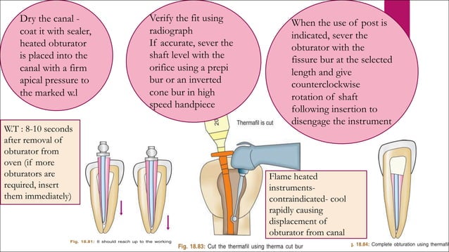 Obturation of Root canal systems or Root canal obturation | PPT