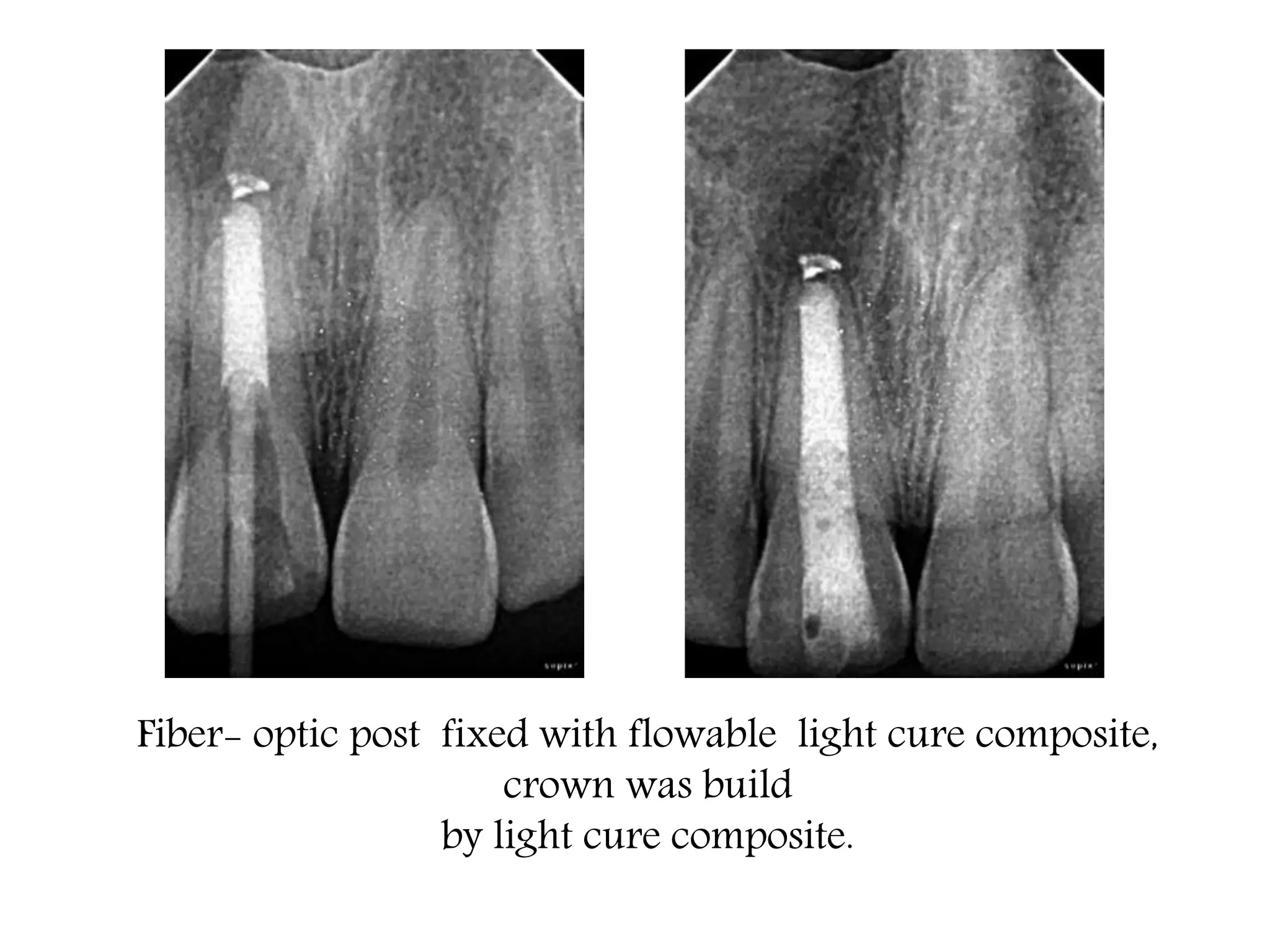 Obturation by mta | PPTX | Dental Health | Diseases and Conditions