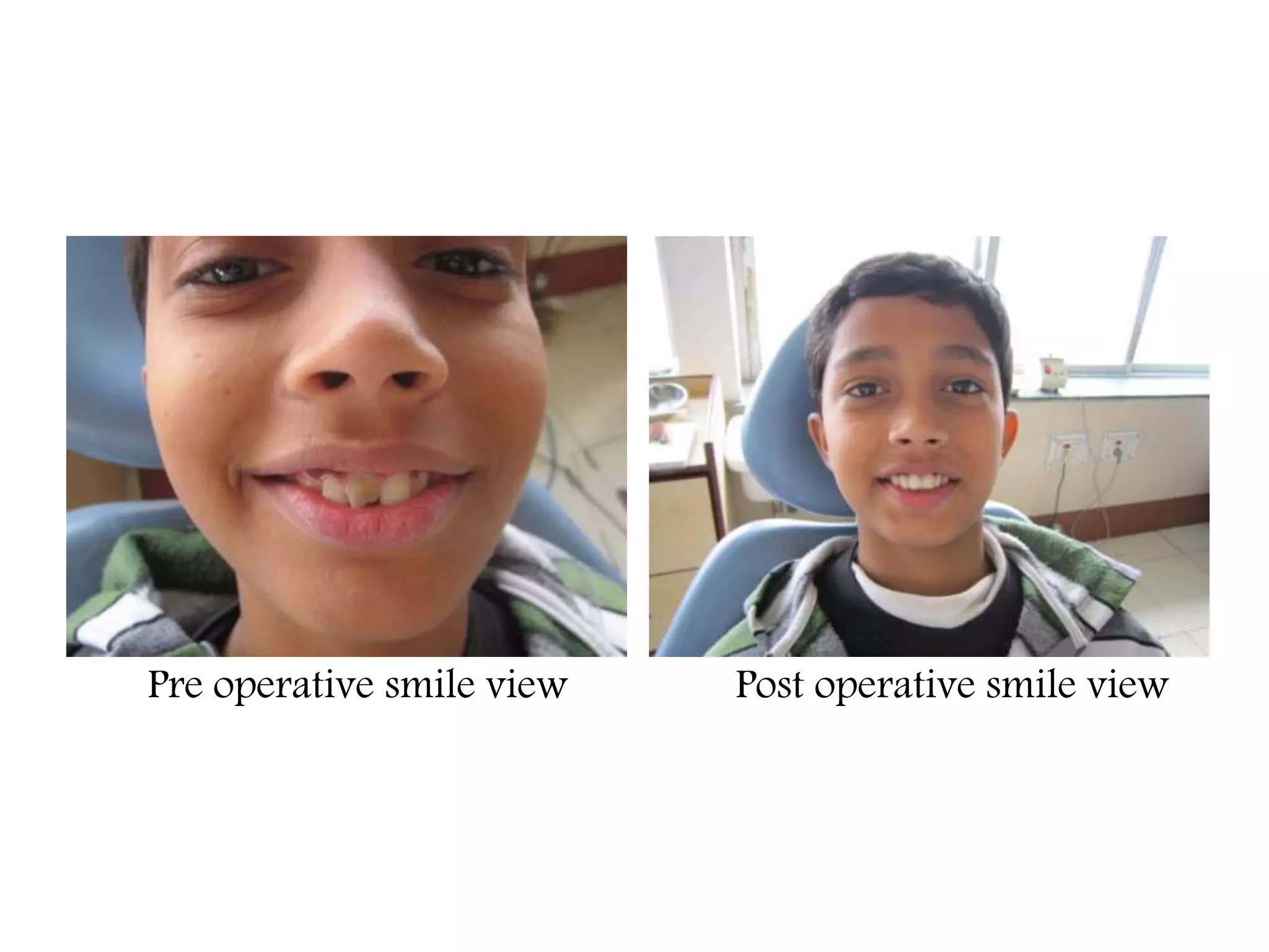 Obturation by mta | PPTX