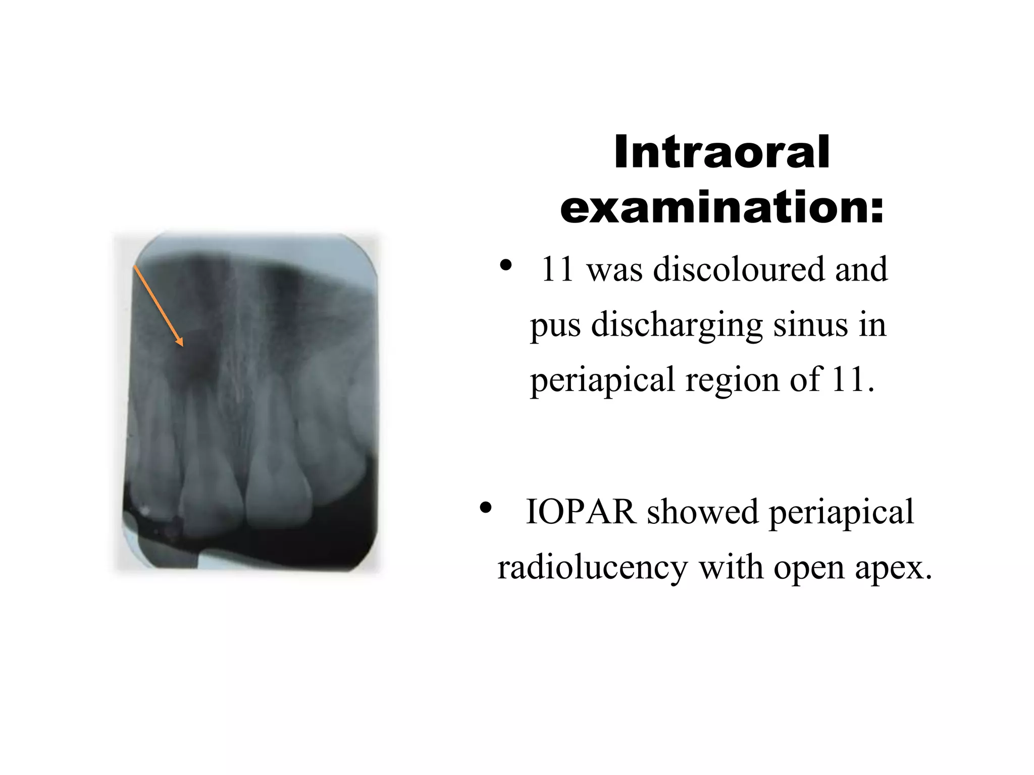 Obturation by mta | PPTX