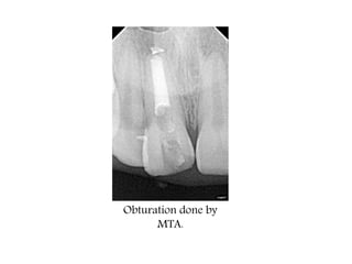 Obturation by mta | PPTX
