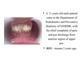 Obturation by mta | PPTX