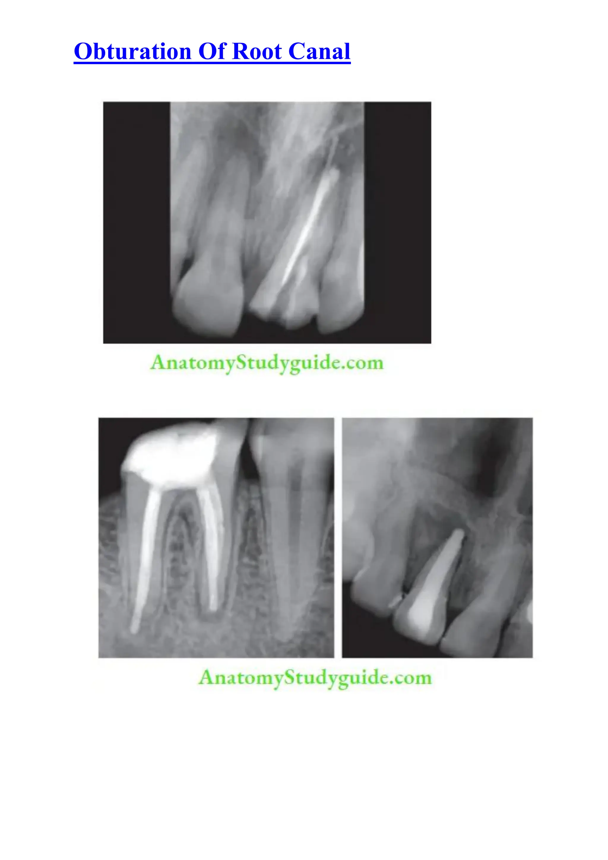 Obturation Of Root Canal Obturation Of Root Canal | PDF