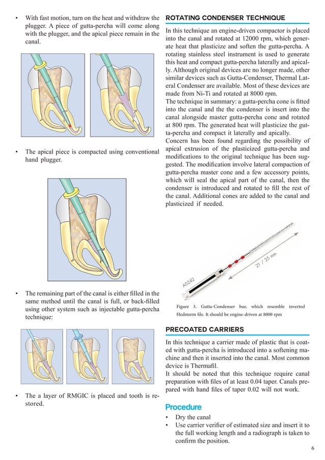 Obturation of Root Canal - An Endodontic Overview | PDF | Dental Health | Diseases and Conditions