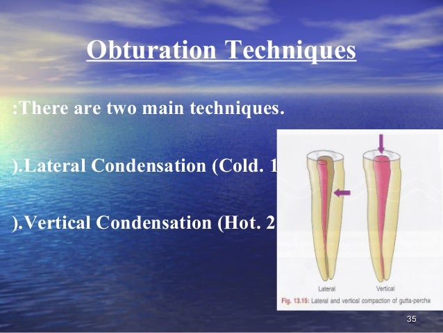 Obturation of root canal system