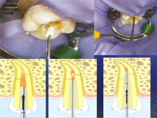 Obturation of root canal system