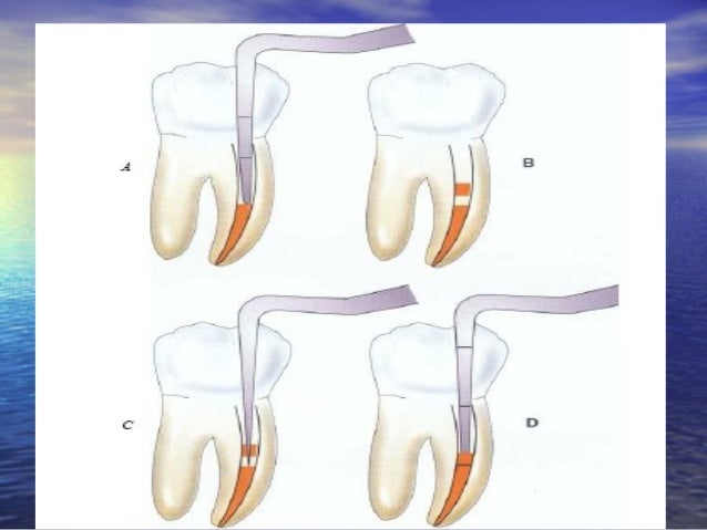 Obturation of root canal system