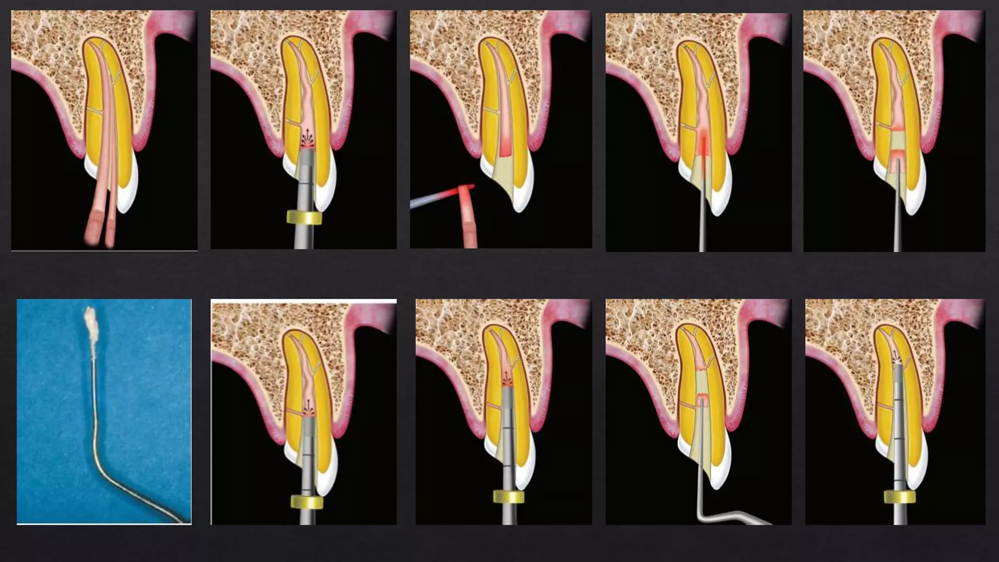 OBTURATION OF ROOT CANAL SYSTEM.pptx