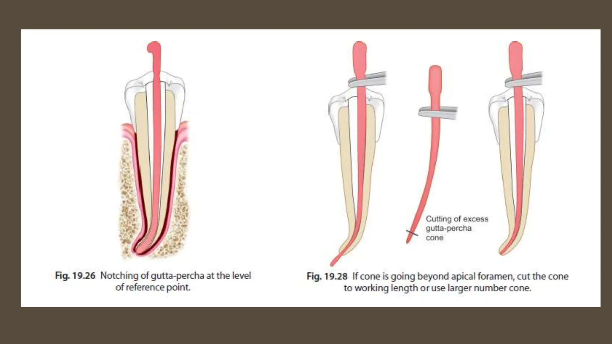Obturation of Root Canal System. .pptx