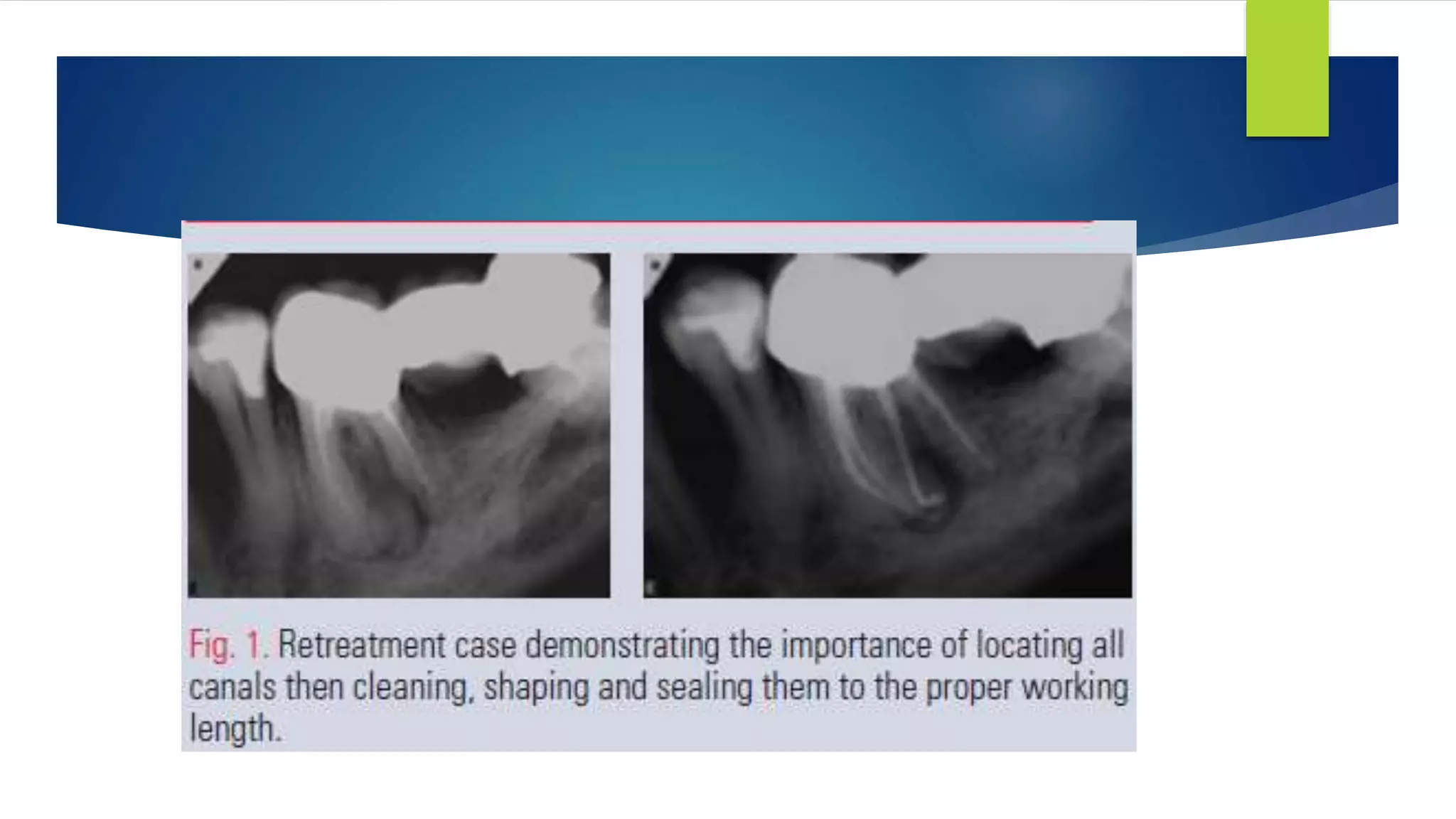 Obturation of root canal systems | PPTX