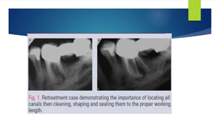 Obturation of root canal systems | PPTX