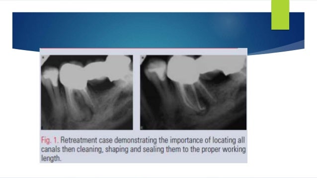 Obturation of root canal systems