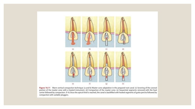 Obturation of the Radicular Space in Endodontics Grossmann | PPT