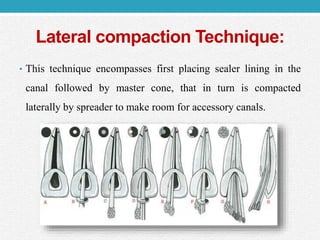 Obturation technique | PPTX