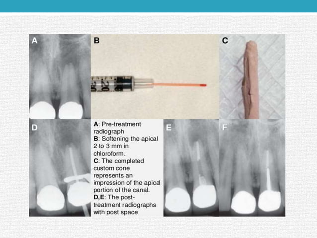 Obturation technique | PPTX | Dental Health | Diseases and Conditions