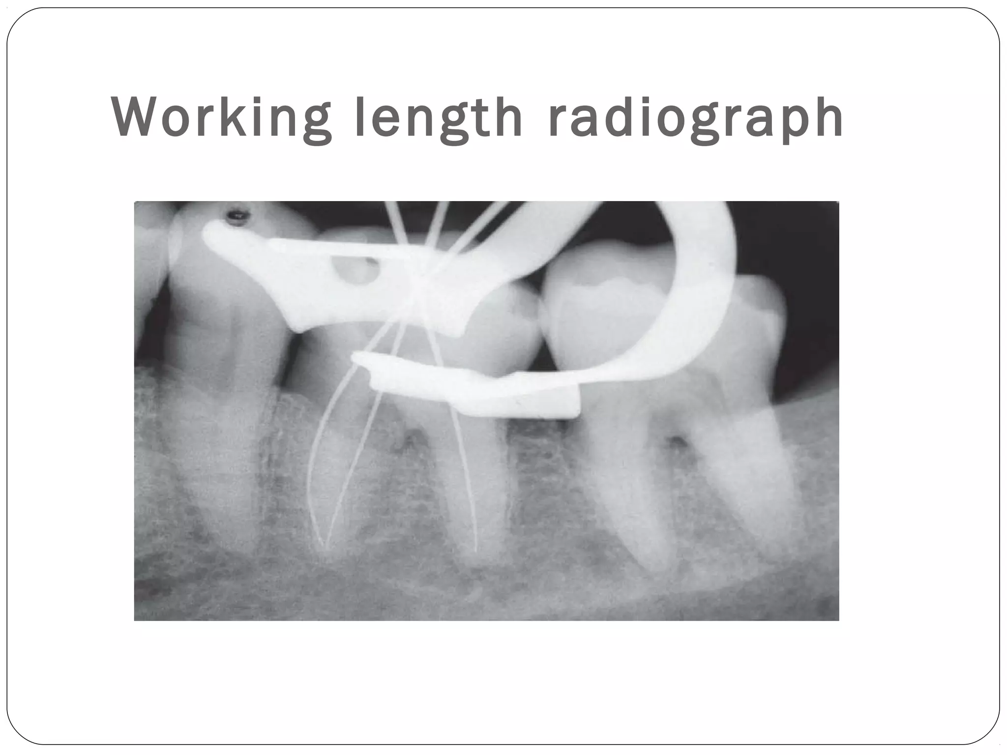 Obturation techniques | PPT