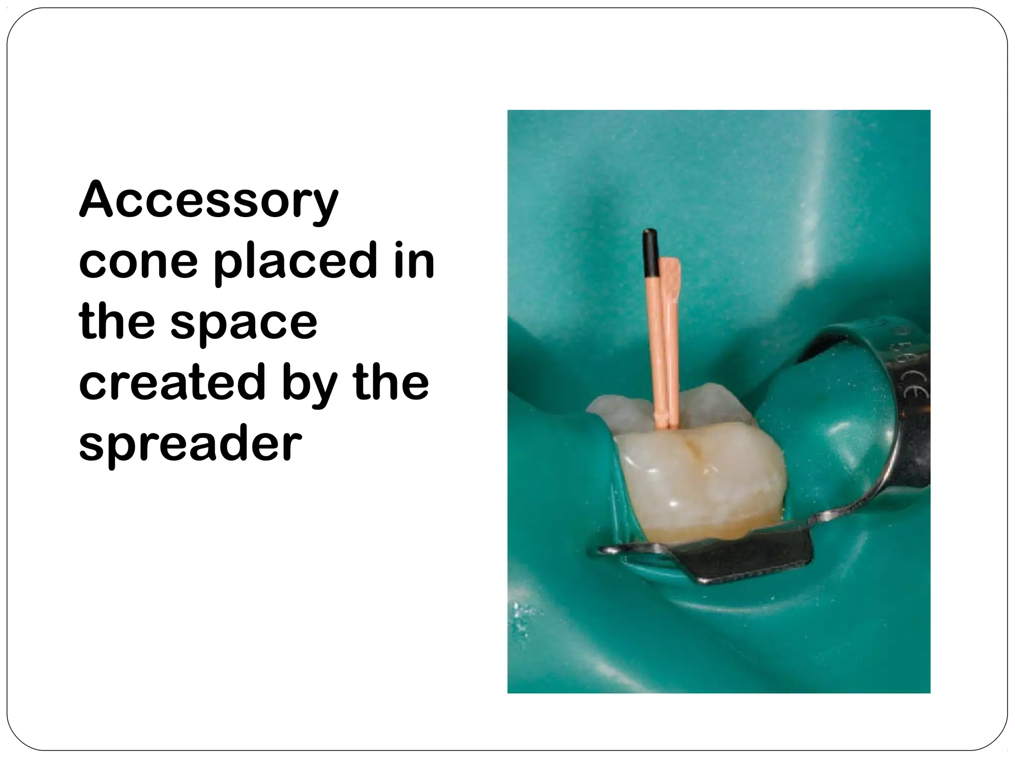 Obturation techniques | PPT