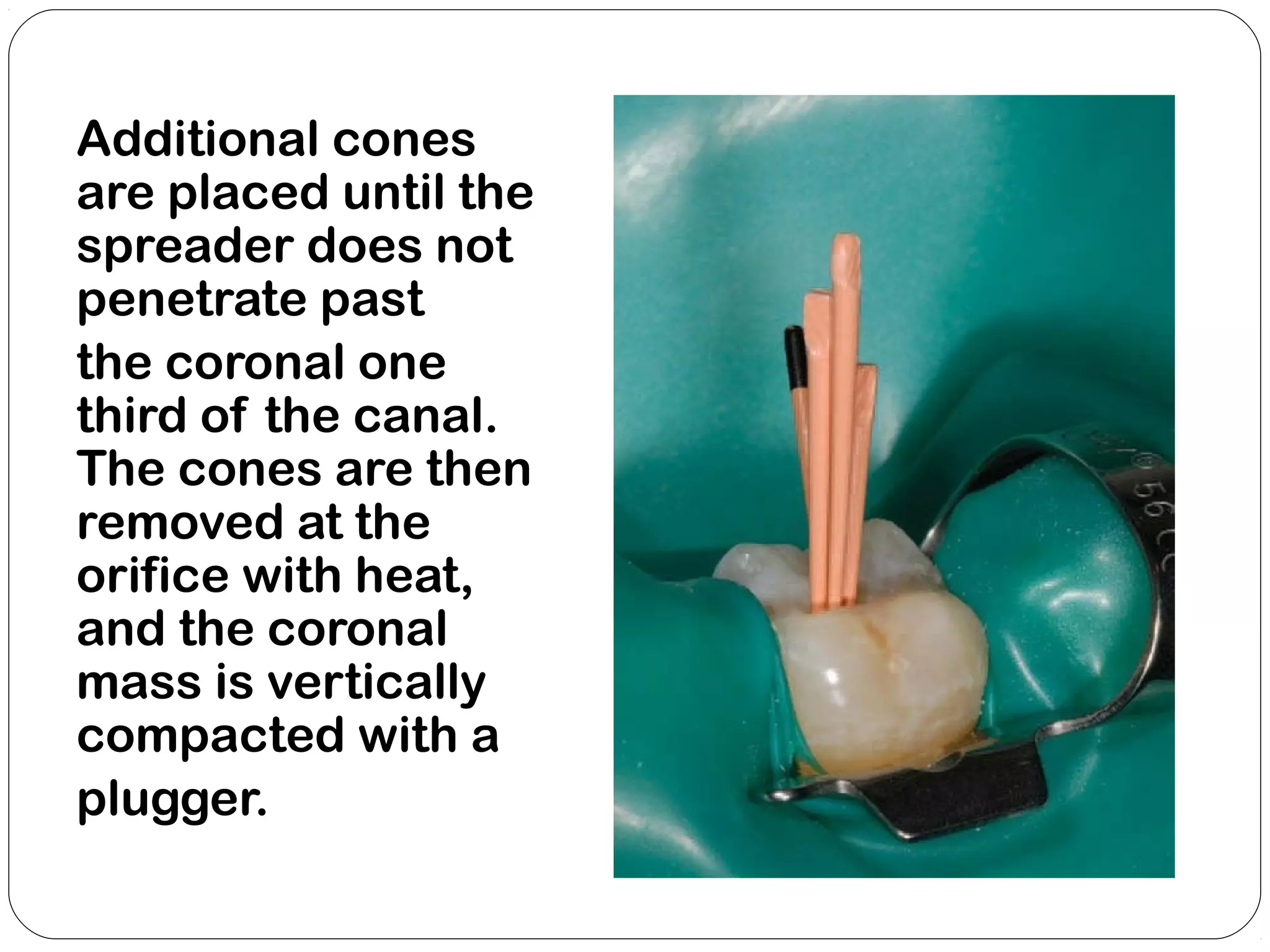 Obturation techniques | PPT