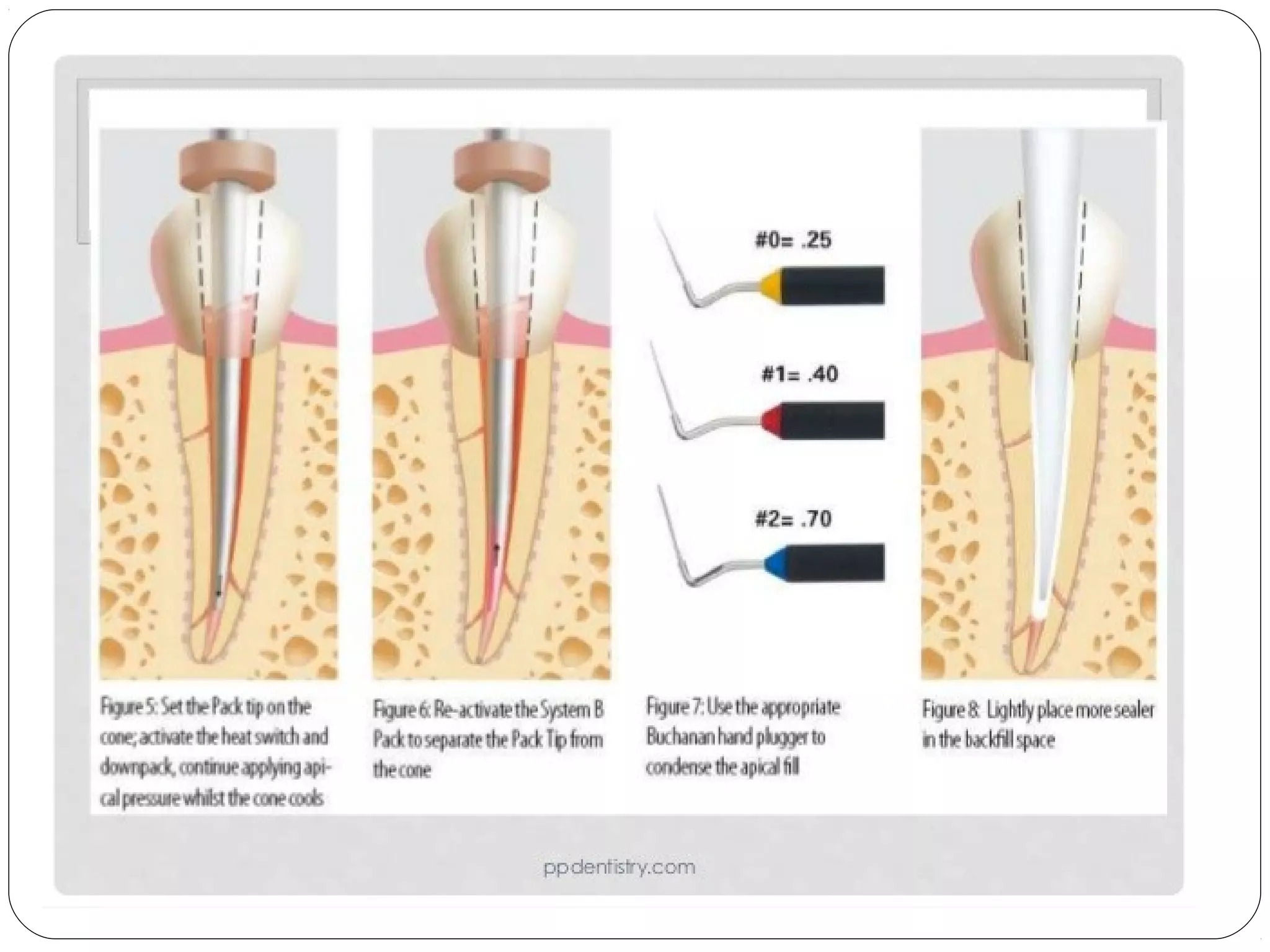 Obturation techniques | PPT