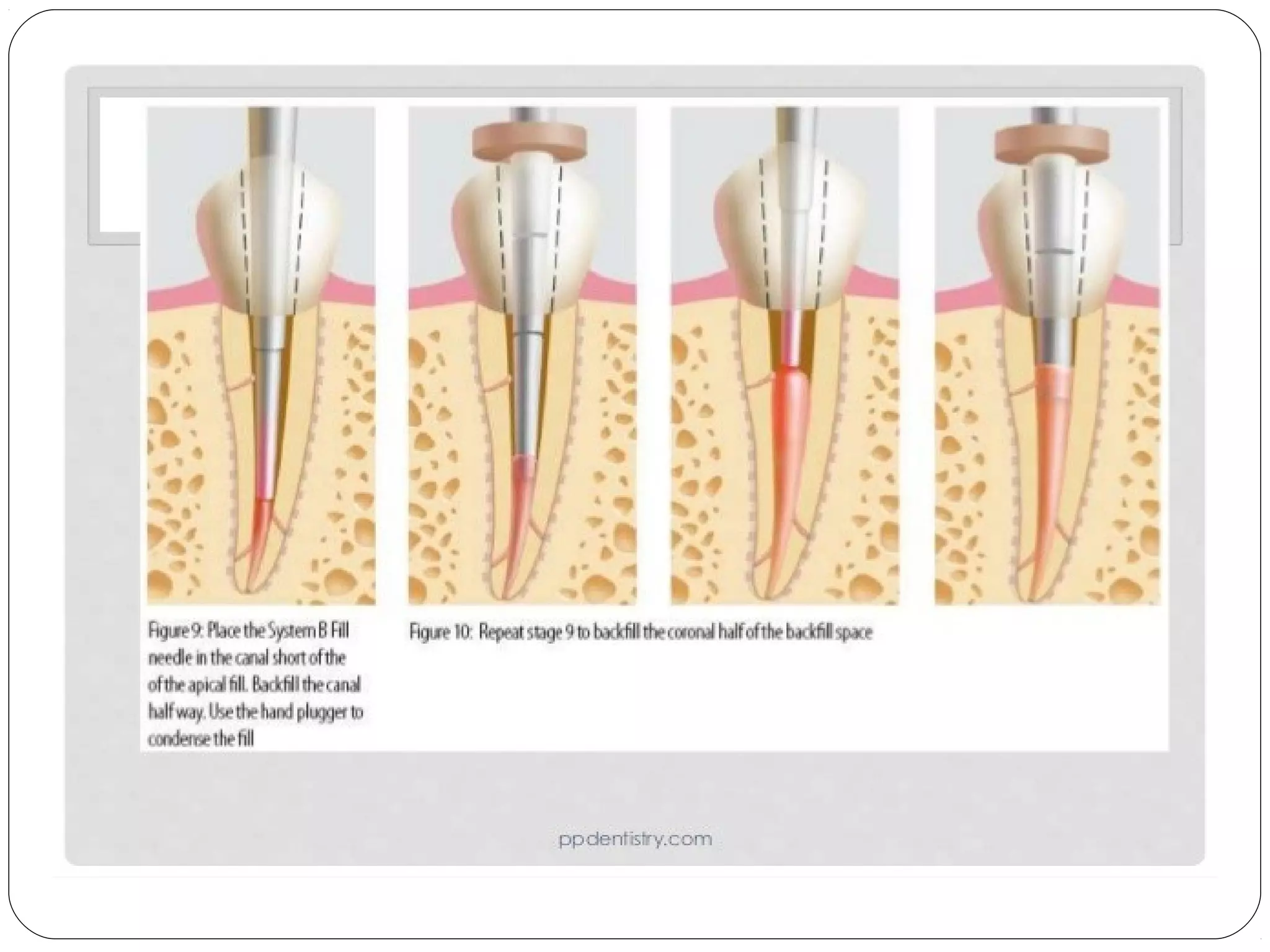 Obturation techniques | PPT