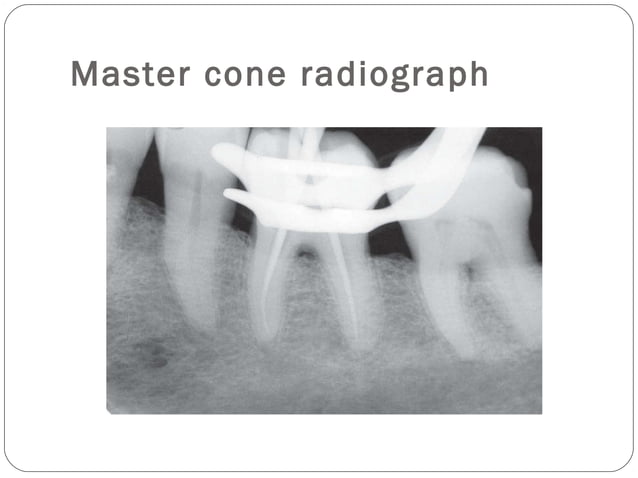 Obturation techniques | PPT