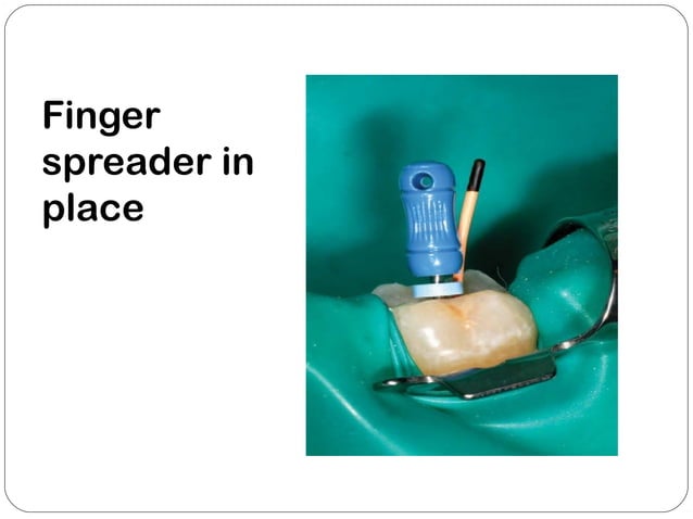 Obturation techniques | PPT