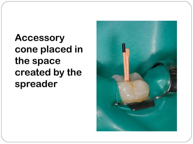 Obturation techniques | PPT