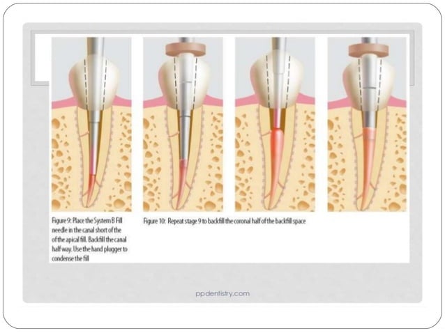 Obturation techniques | PPT