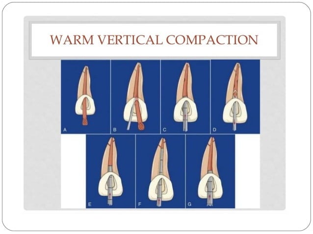Obturation techniques