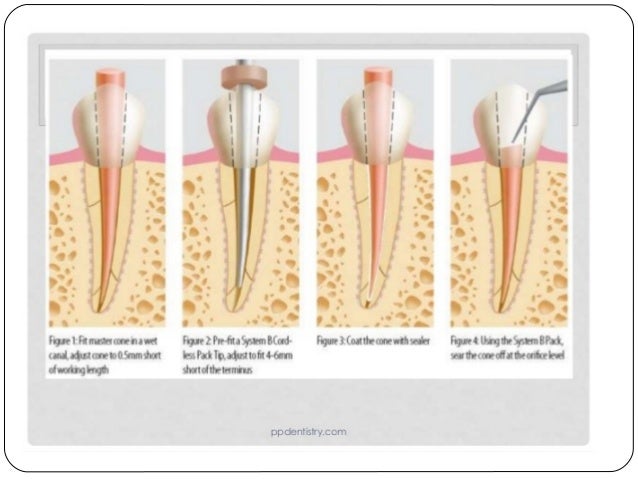 Obturation techniques
