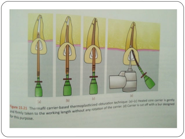 Obturation techniques