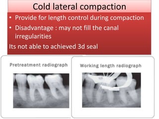 Obturation techniques | PPTX