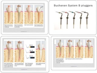 Obturation techniques | PPTX