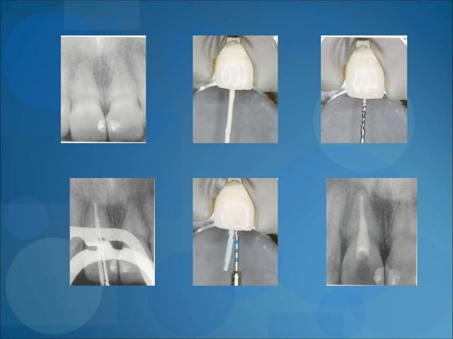 obturation techniques | PPT | Oral care | Personal Care