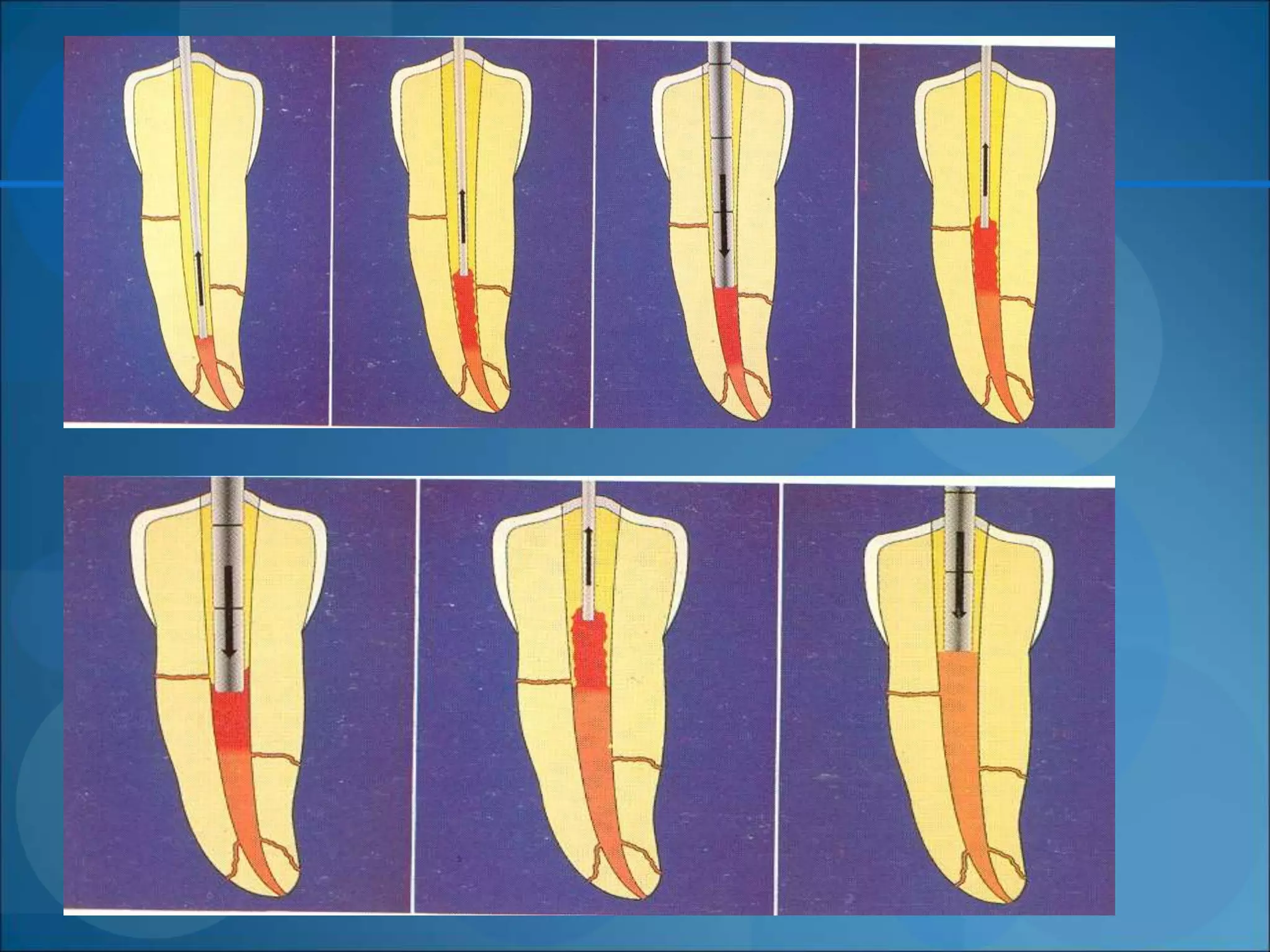 obturation techniques.ppt