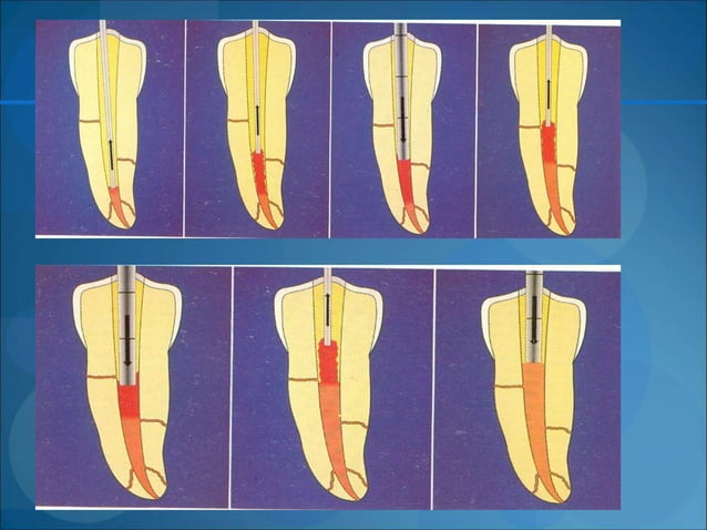 obturation techniques.ppt