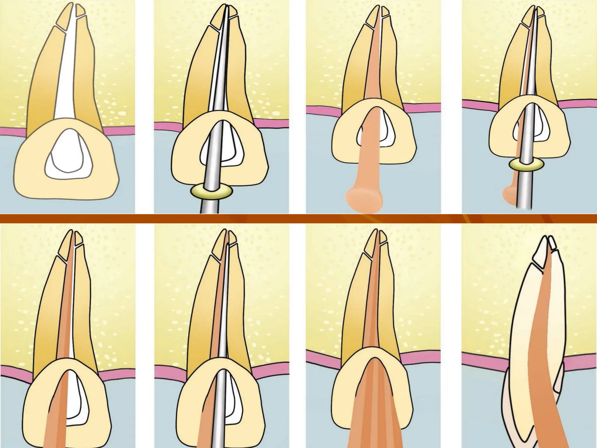 OBTURATION TECHNIQUES ,methods, types and uses | PPT