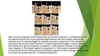 obturation techniques in endodontics.pptx