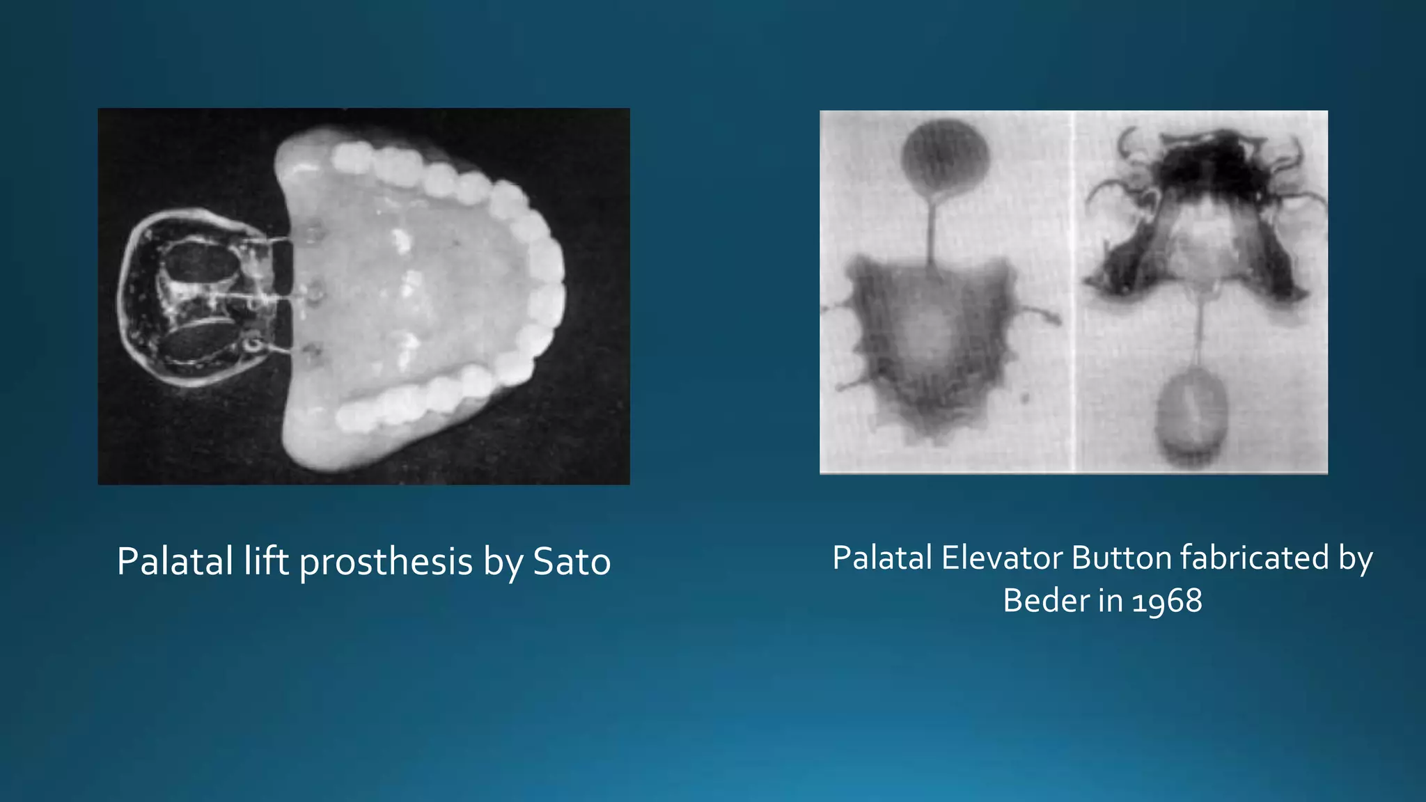 Obturator prosthesis for management of maxillary defects | PPTX