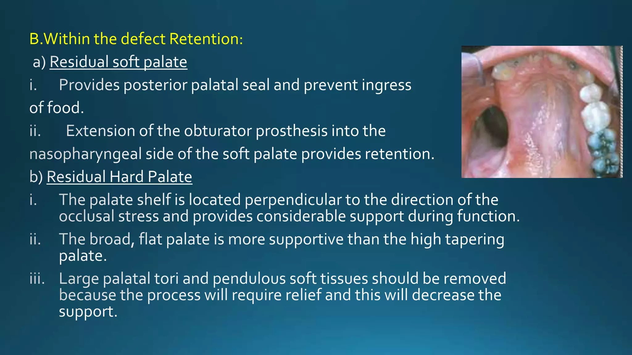 Obturator prosthesis for management of maxillary defects | PPTX
