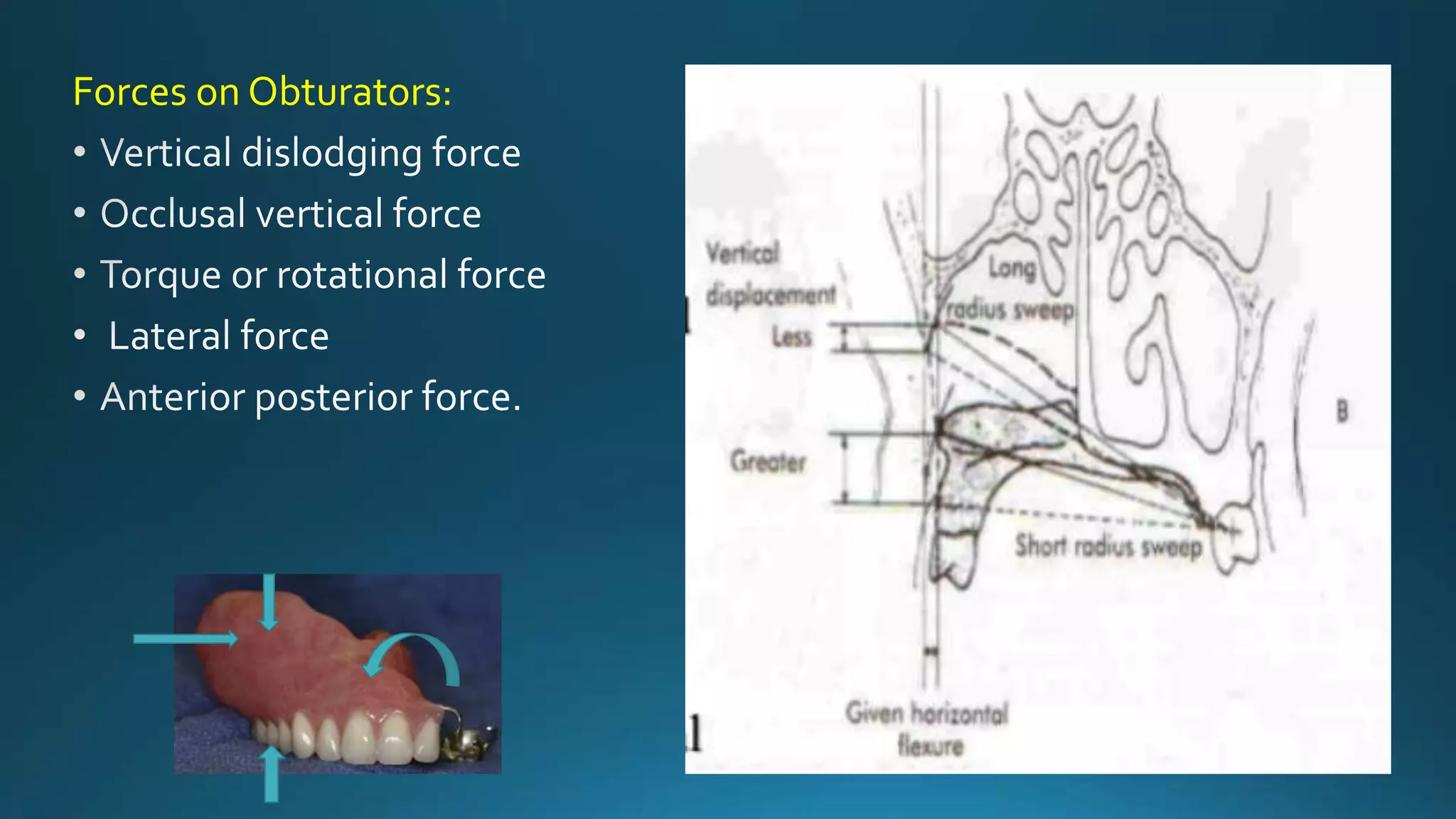 Obturator prosthesis for management of maxillary defects | PPTX