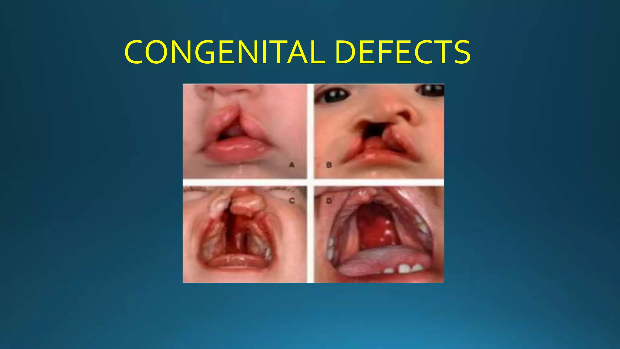 Obturator prosthesis for management of maxillary defects | PPTX