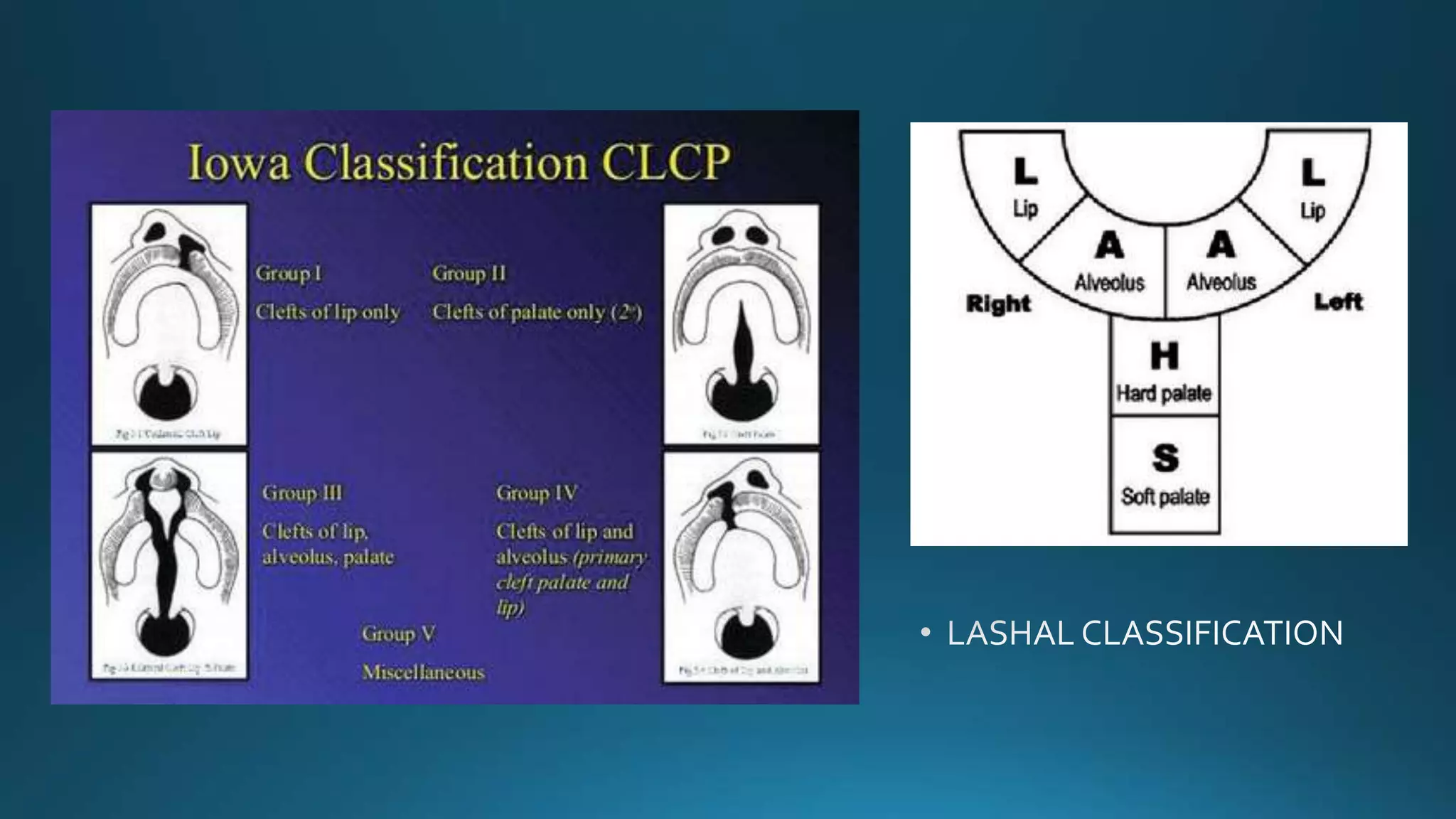 Obturator prosthesis for management of maxillary defects | PPTX