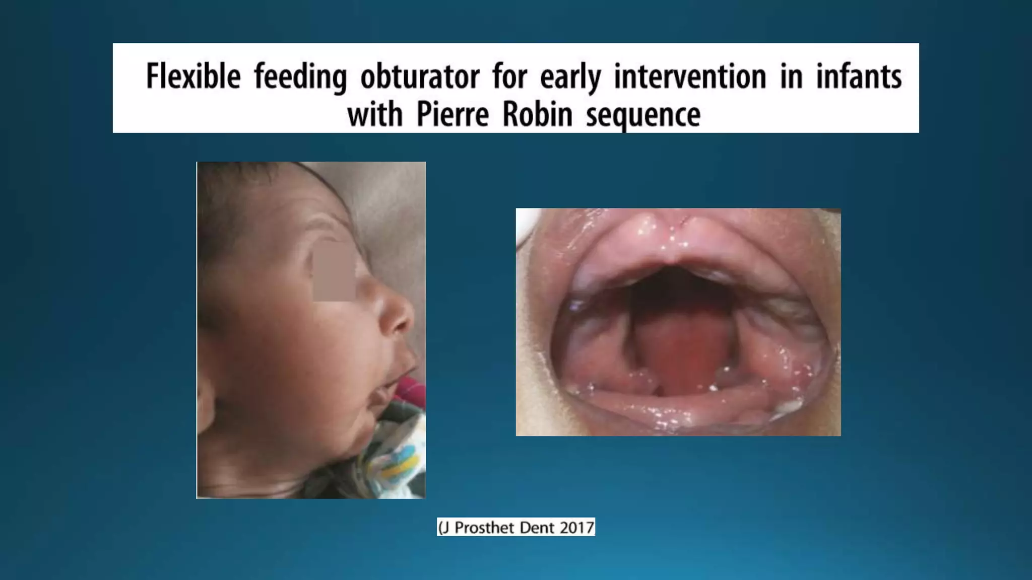 Obturator prosthesis for management of maxillary defects | PPTX