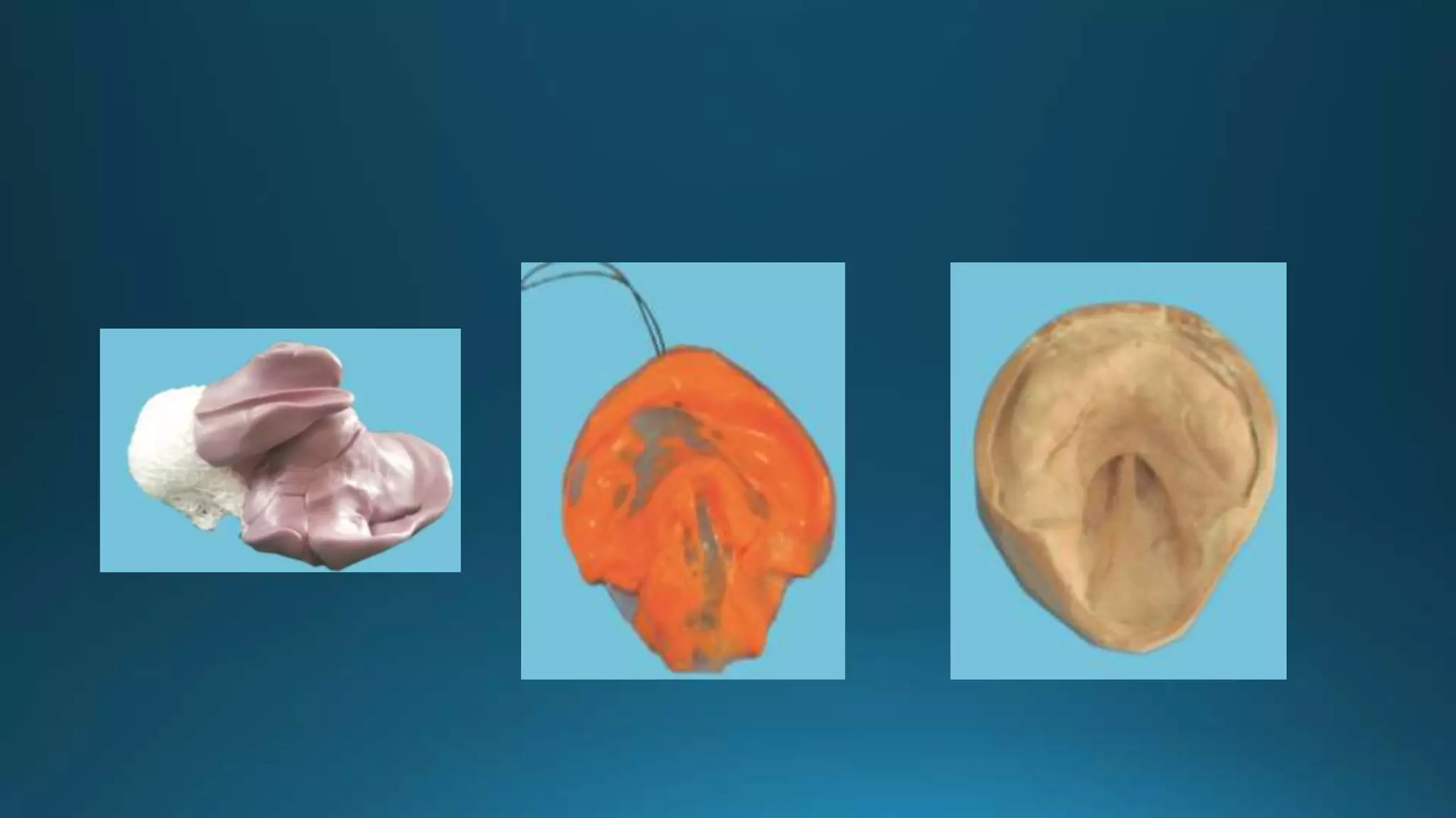 Obturator prosthesis for management of maxillary defects | PPTX