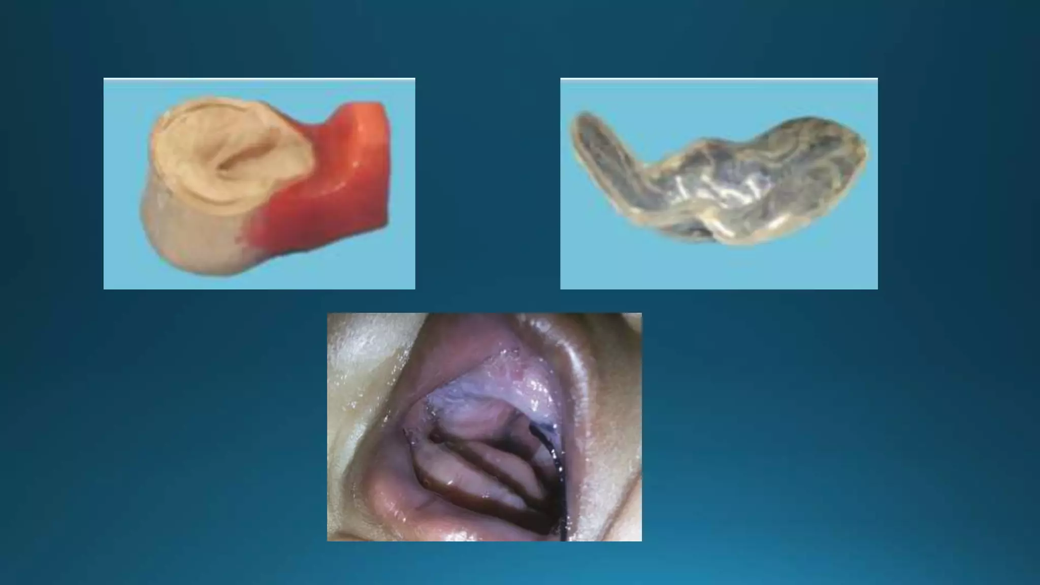 Obturator prosthesis for management of maxillary defects | PPTX